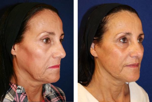 Minilifting per al rejoveniment facial – Institut Cimax